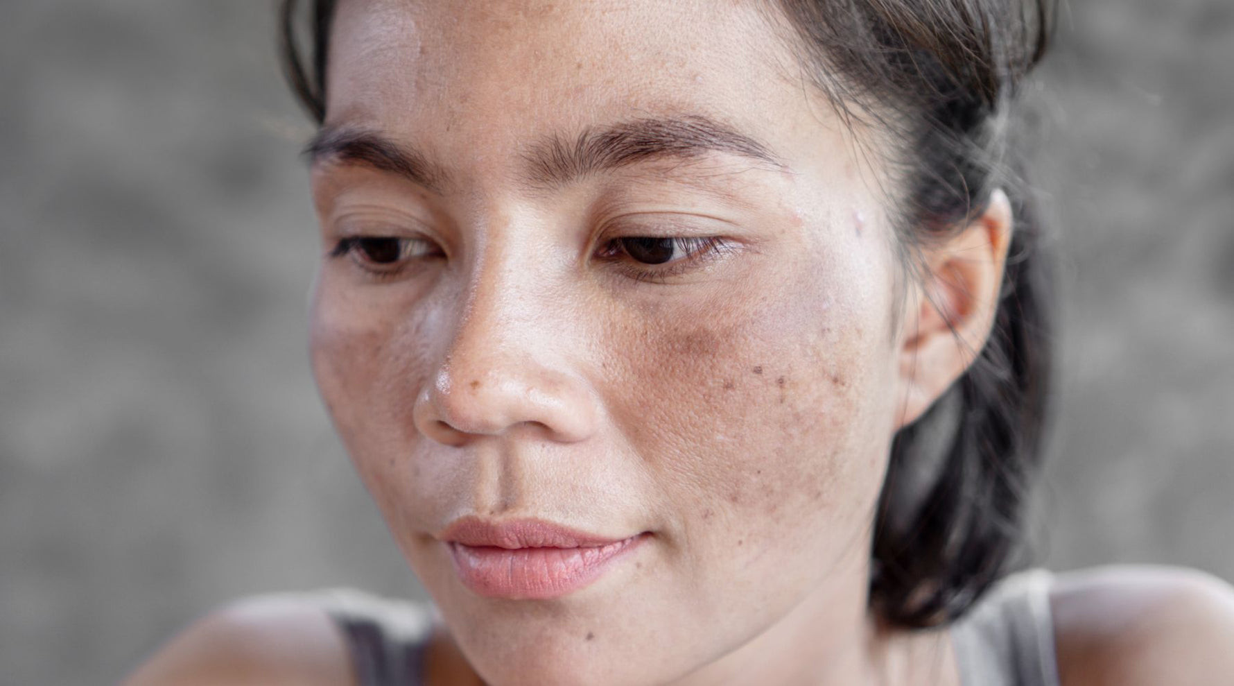 Red Light Therapy for Hyperpigmentation: A Complete Guide – Nicebeam