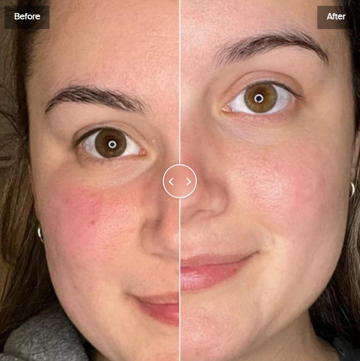 Led Light Mask Before and After: Real Transformations & 2026 Guide ...